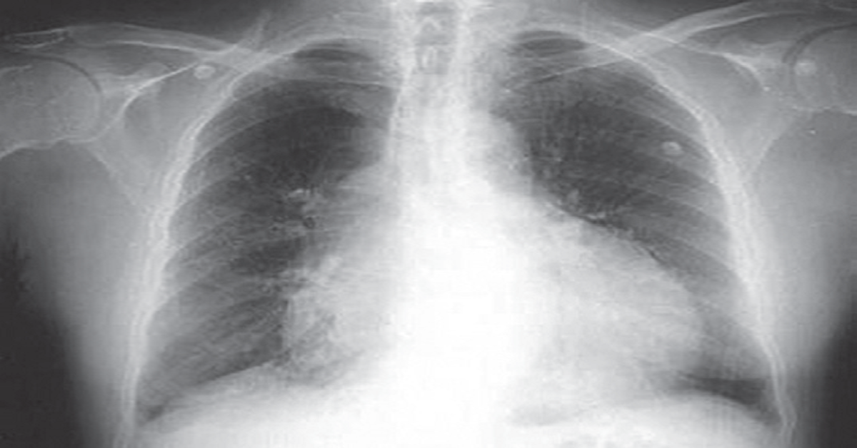 What Is Pericardial Effusion? - Teroes