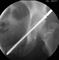 Minimally Invasive Screw Fixation of Symptomatic Pubic Ramus Nonunions ...