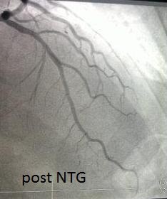 LAD SPASM - Sumer's Radiology Blog