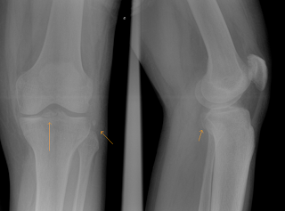 ACL Tear-Plain Film Signs - Sumer's Radiology Blog