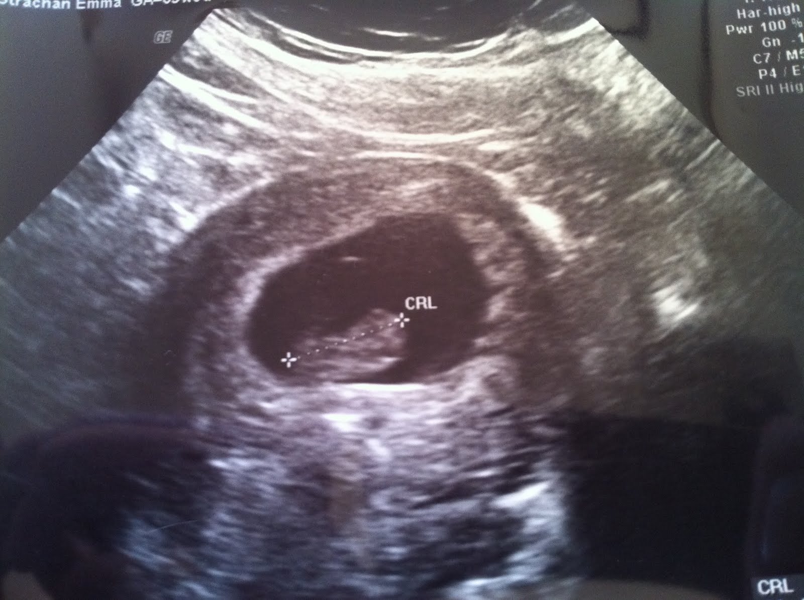 The Baby Making Files: 9 week Scan Pics...