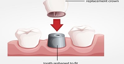 extracted wisdom tooth: Crown Sensitivity…How Long Should To It Last?