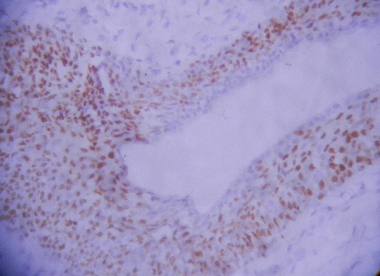 into the roots: Mimickers of prostate carcinoma