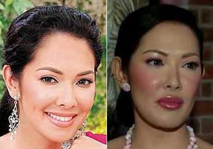 Philippine Actresses That Have Undergone Surgery | Gossip Ghirl
