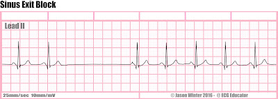 ECG Educator Blog : Six Second ECG Rhythm Strips