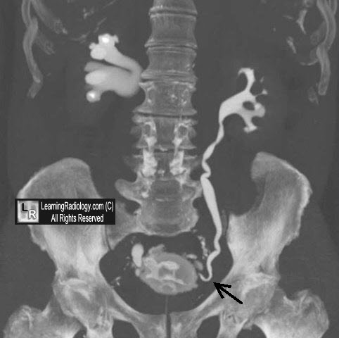 BENIGN PROSTATE HYPERPLASIA