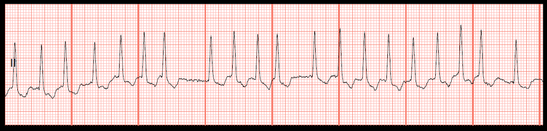 Float Nurse: Practice EKG Strips 399