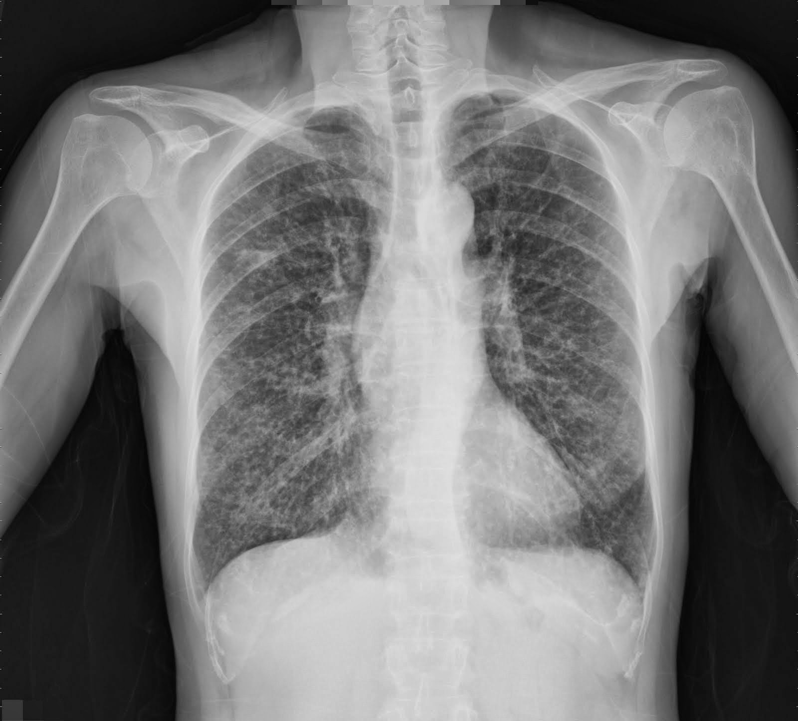 CXR 胸部x光判讀 Diffuse panbronchiolitis