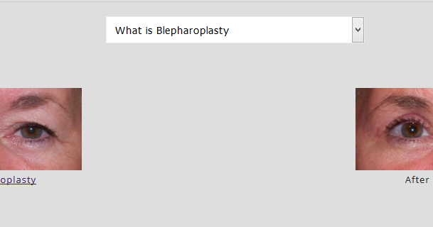 Oculo Facial Consultants Dr Mark S Brown What Is Blepharoplasty 