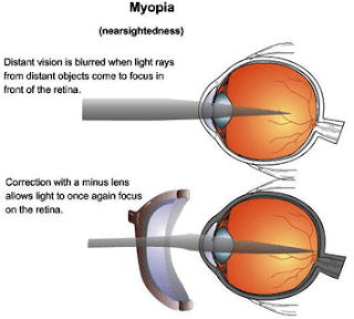Jenis Kelainan Refraksi Dan Solusinya - Kelainan Pada Mata - Biologisites