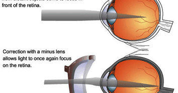 Jenis Kelainan Refraksi Dan Solusinya - Kelainan Pada Mata - Biologisites
