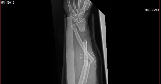 Worst Hand Forearm Injury Open fracture called Compound fracture: Worst ...
