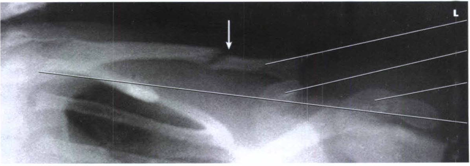 TEKNIK RADIOGRAFI CLAVICULA - Radiografer