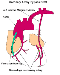 OTMANAGE: Cardiovascular Surgery CABG