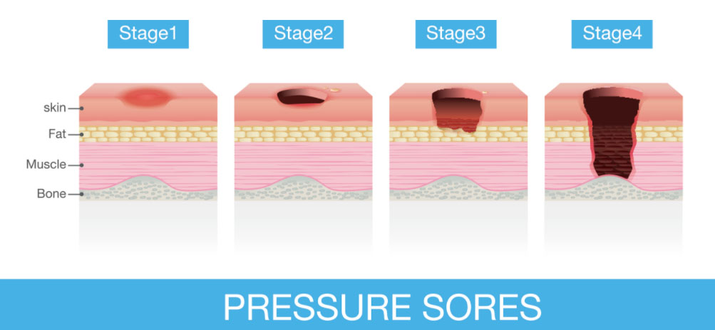 Dietitians Online Blog: Pressure Ulcer Awareness Day - Pressure Injury ...