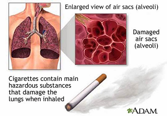 Signs of emphysema | Signs of emphysema
