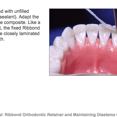 Dental Mart: Ribbond Ribbon Orthodontics 1mm