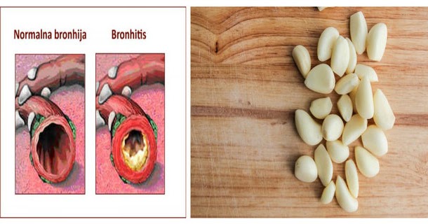 Prirodni lijekovi: Prirodni lijekovi protiv Bronhitisa