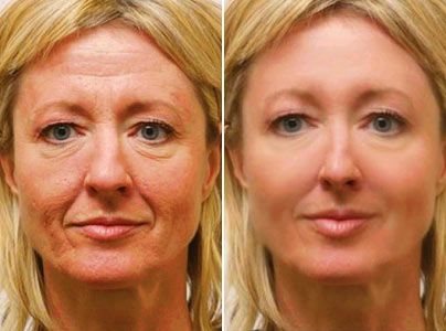 Erase And Reduce Brow Creases At Home Naturally With Face Exercises
