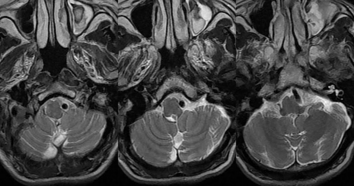 Neuroradiology Cases: Vertebral Artery compressing Medulla