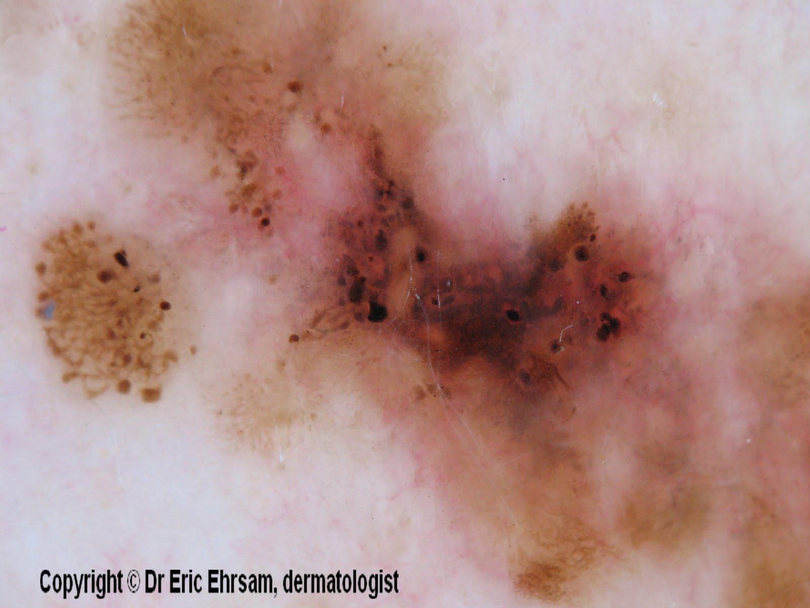 dermoscopy: July 2011