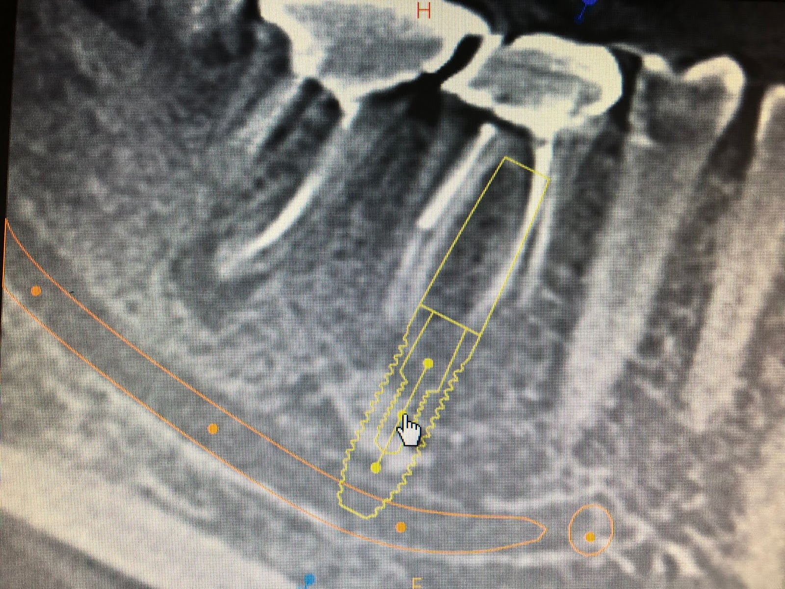 Are Dental Implants Safe?