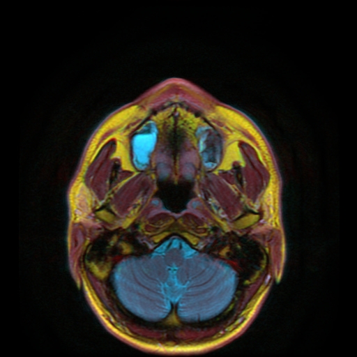 Nevit's blog: Color MRI of the Neck