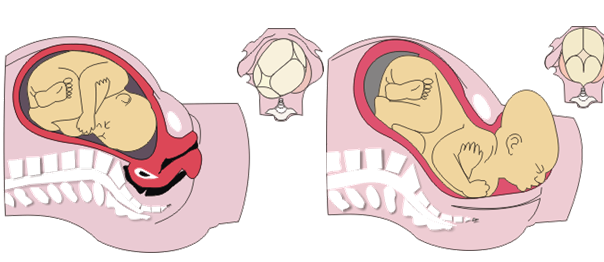 PARTOS TECNOLÓGICOS Y NATURALES