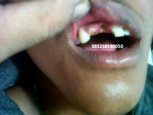 S.A.S - AHLI GIGI KOTA PATI, Jateng & KOTA JEMBER, Jatim: Foto Contoh ...