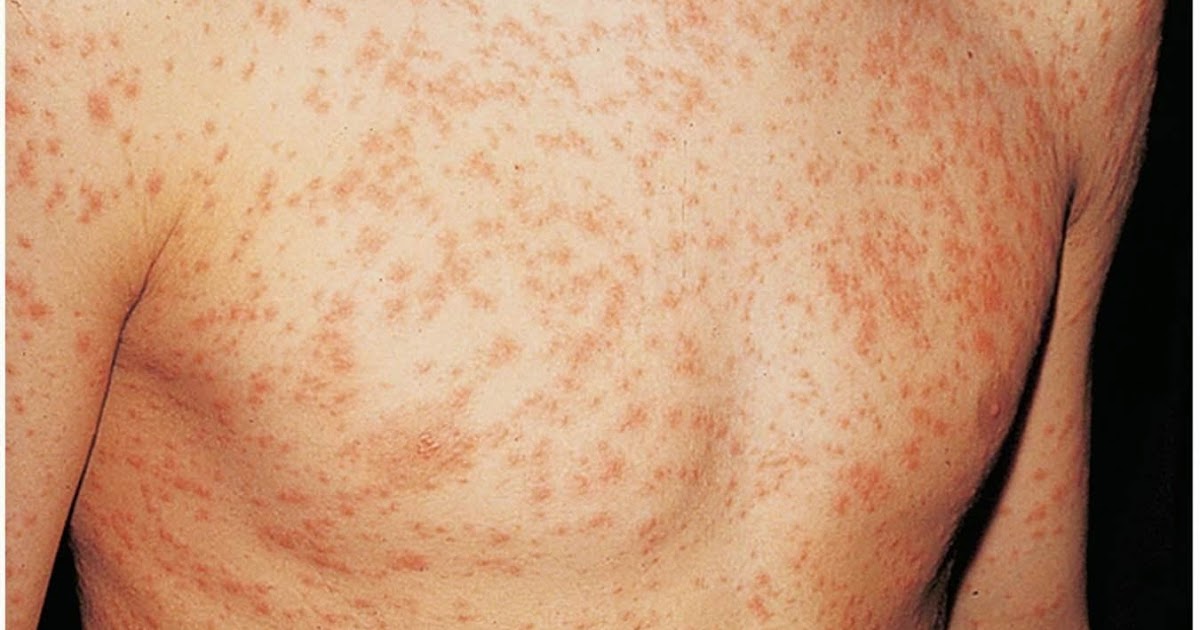 Rubéola Congênita e a eficácia da vacinação: Sintomas