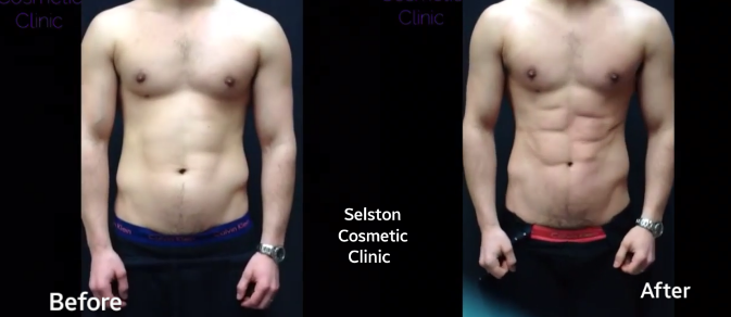 Selston Cosmetic Clinic: Vaser Lipo Treatment For Male Abs - Nottingham ...