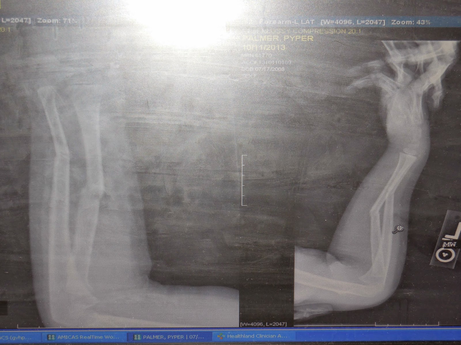 The Palmer People: Oct 11th, 2013 Poor Pyper and her broken arm.