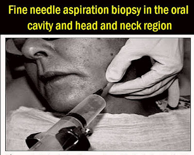 PDF: Fine needle aspiration biopsy in the oral cavity and head and neck ...