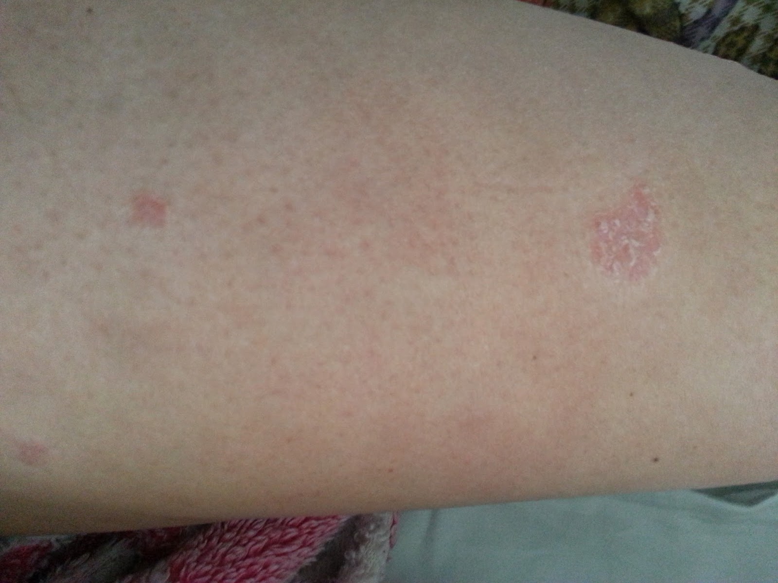 Psoriasis & TCM documentary