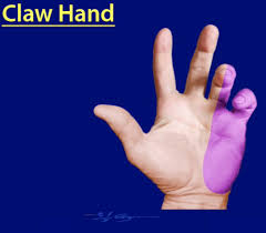 Claw Hand, or 'Spinster's Claw #medical article #anatomy - LANKA STUDENTS