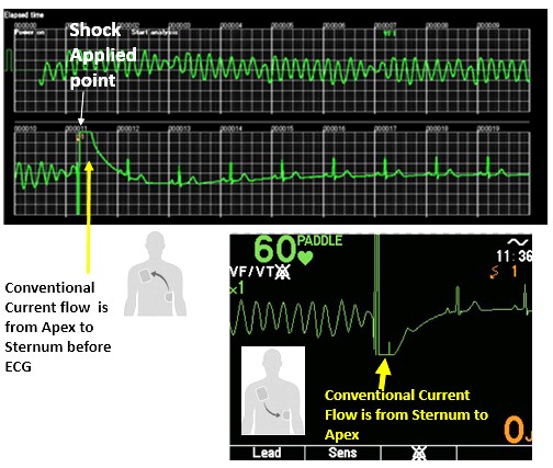 Medical Devices Sanity: CardioLife Acti-Biphasic defibrillation Waveform