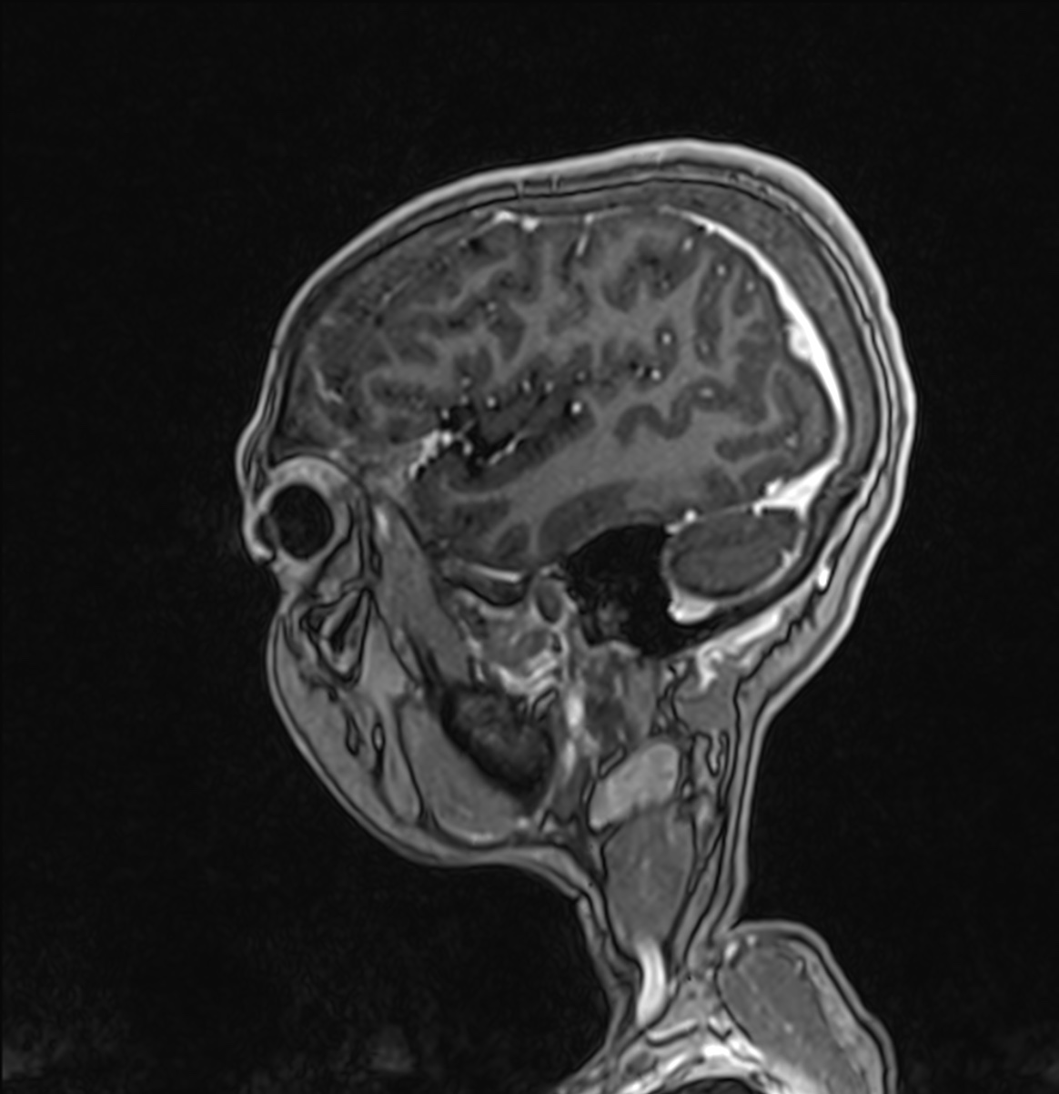 Ultimate Radiology : Hypertrophic Pachymeningitis
