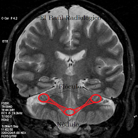El Baúl Radiológico: LÓBULO FLOCULONODULAR CEREBELOSO. (The Cerebellar ...