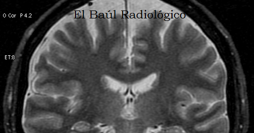 El Baúl Radiológico: LÓBULO FLOCULONODULAR CEREBELOSO. (The Cerebellar ...
