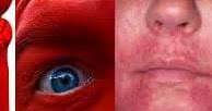 Health Red man syndrome disease - www.24wikiss.blogspot.com