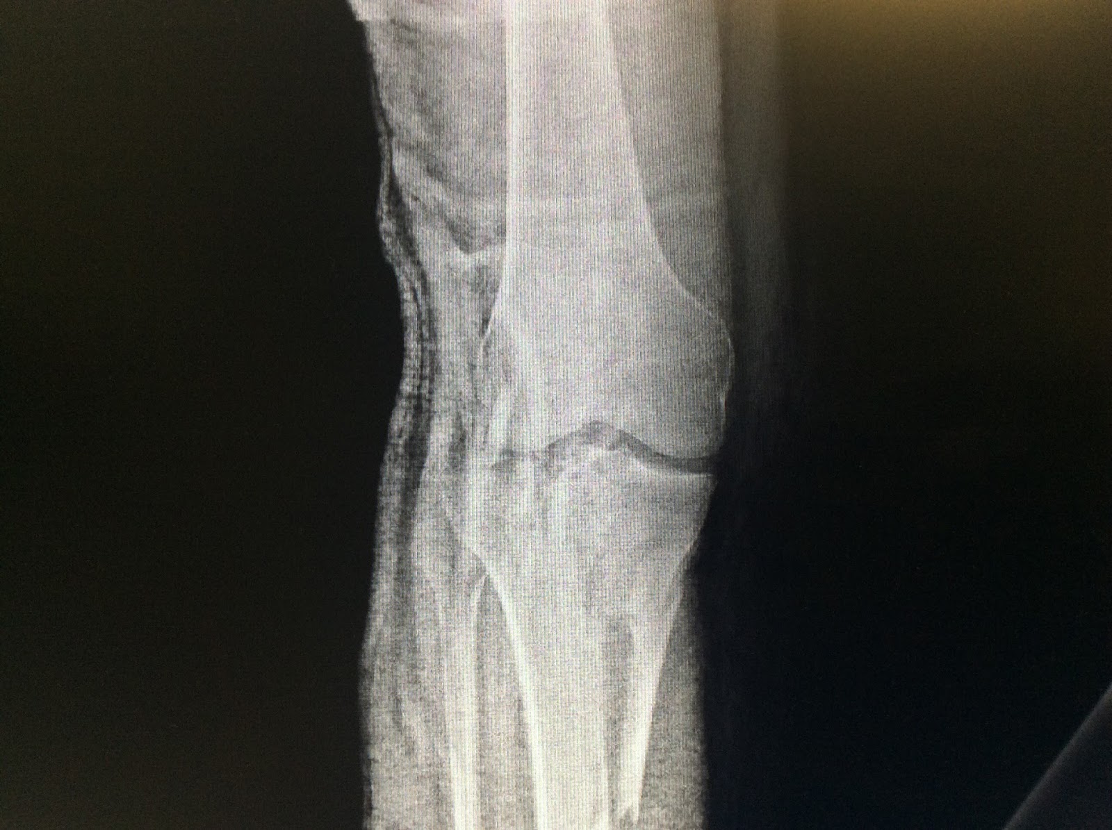O R T O C R I T I C A: FRACTURA DE MESETA TIBIAL