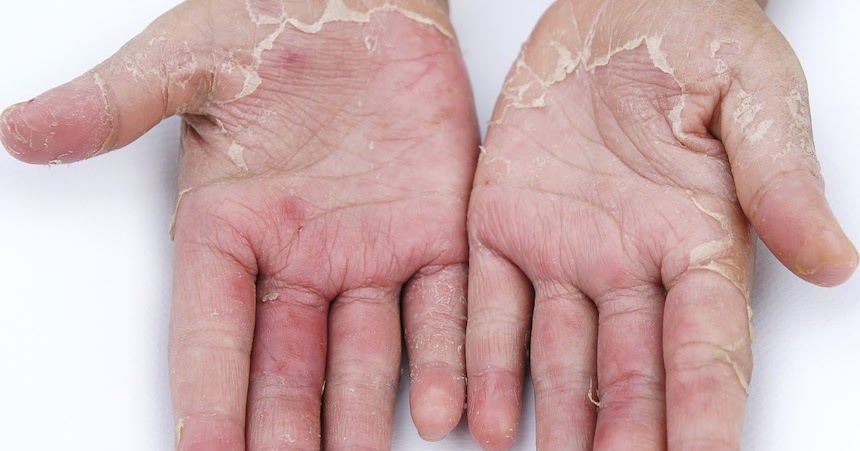 Dishidrotik Dermatit Nedir? Nedenleri, Belirtileri, Tanısı ve Tedavisi