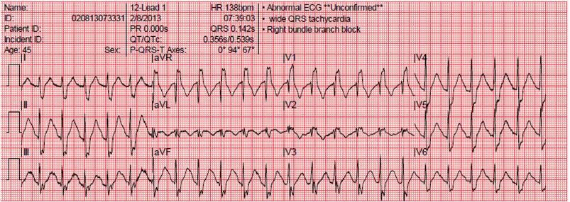 ECGs for EMS: Deadly 12 Lead ECG Diagnosis: Pulmonary Embolism