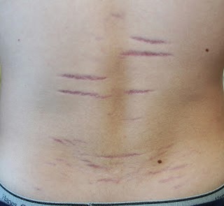 Cara Alami Menghilangkan Stretch Mark | Cara Kecantikan Wanita