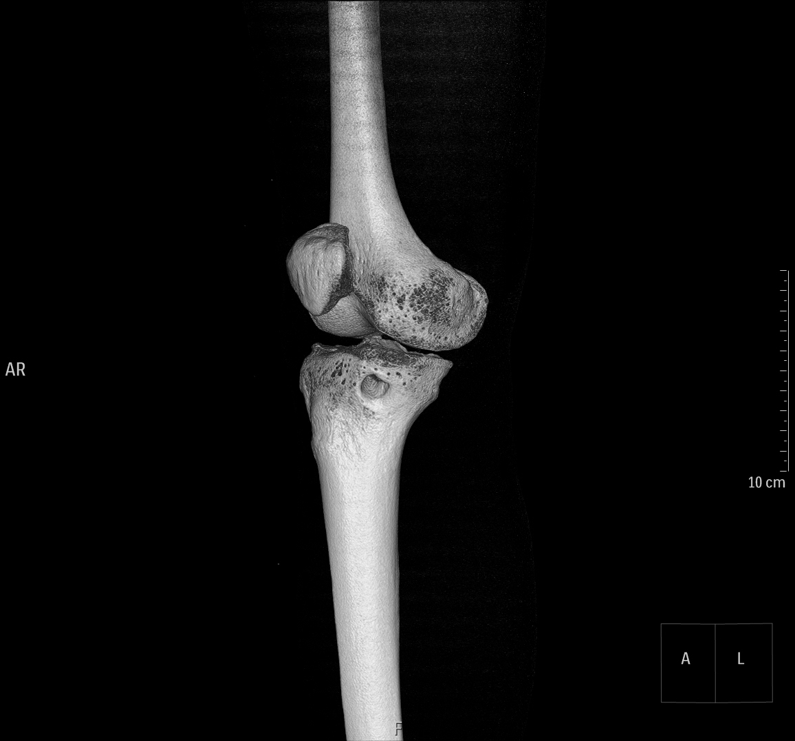 CT Knee - Radiology Imaging