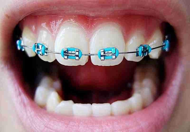 PerahuKertas: feyraaashop [ FASHION FAKE BRACES ]