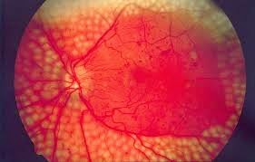 Medical Treatment Pictures-for Better Understanding: Retinal Laser ...