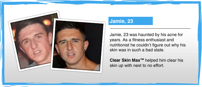 ClearSkinMax Reviews: Buy Clear Skin Max, Get rid of Acne, Clear ...