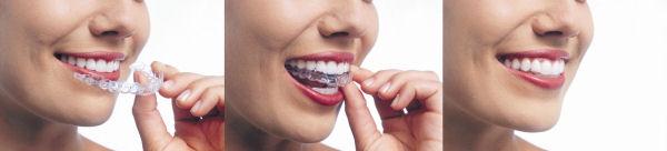 Invisalign adalah | Dokter Gigi