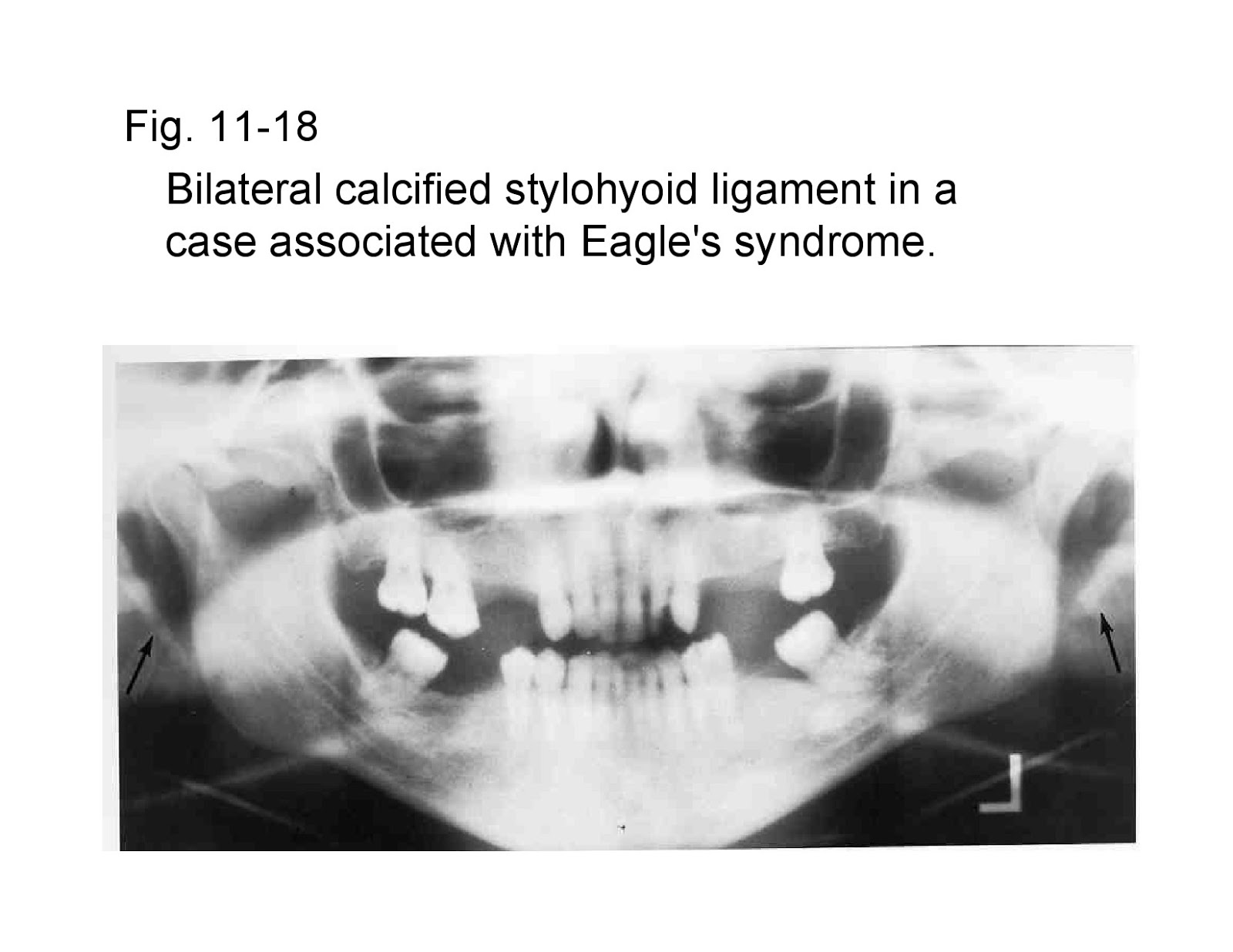 Dentistry and Medicine: SOFT TISSUE CALCIFICATIONS IN ORO-MAXILLO ...